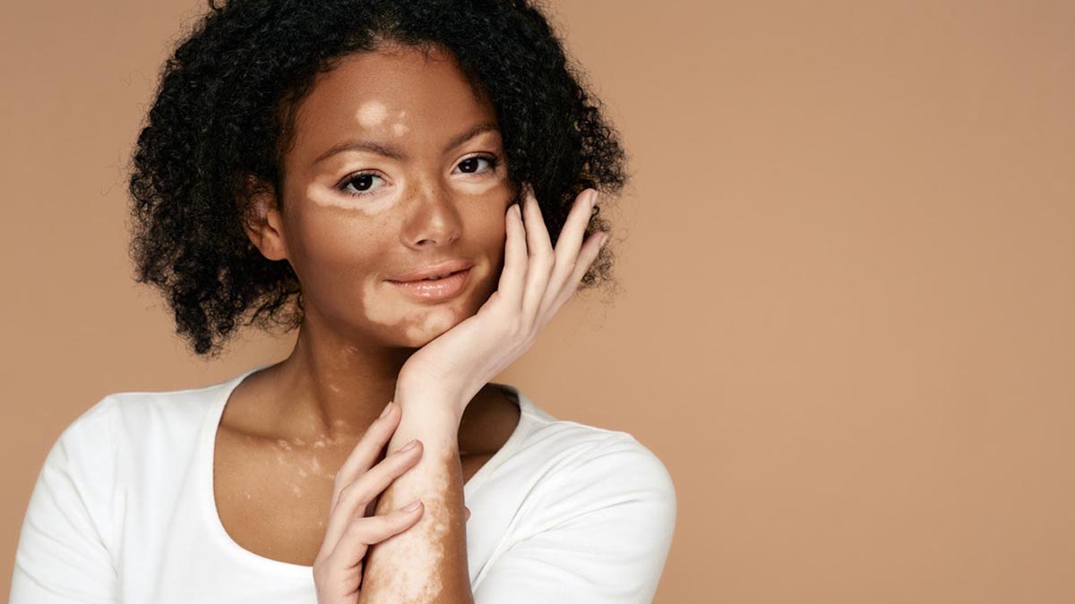 What Is Vitiligo and How Is It Connected to Diabetes? - Diabetes Self ...